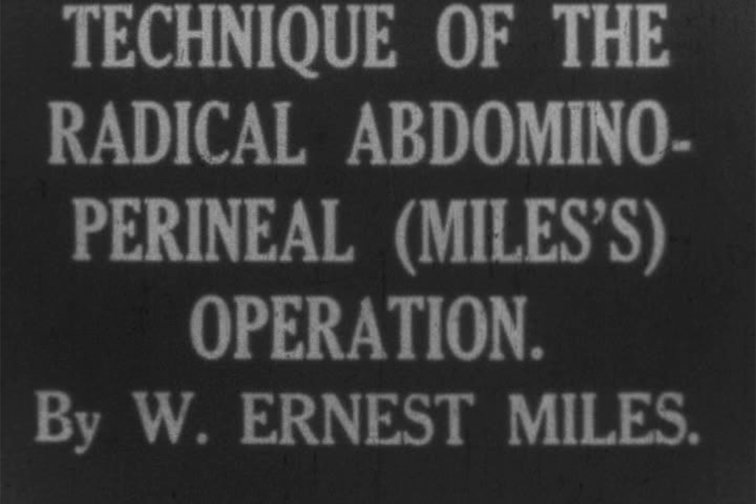Technique of the radical abdomino-perineal (Miles's) operation – London ...