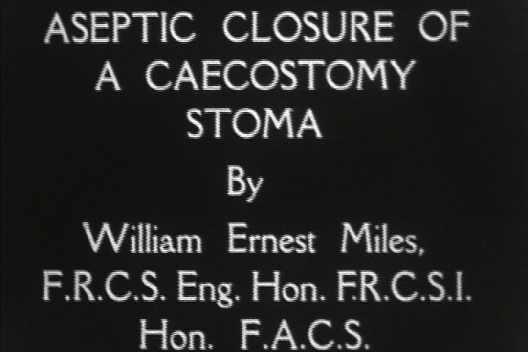 Aseptic closure of a caecostomy stoma – London's Screen Archives – Title